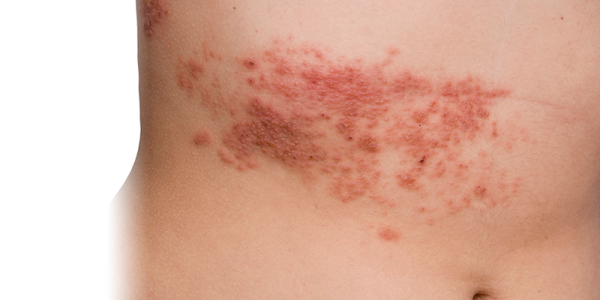 Understanding Shingles: Causes, Symptoms, and Treatment | Our Experts ...