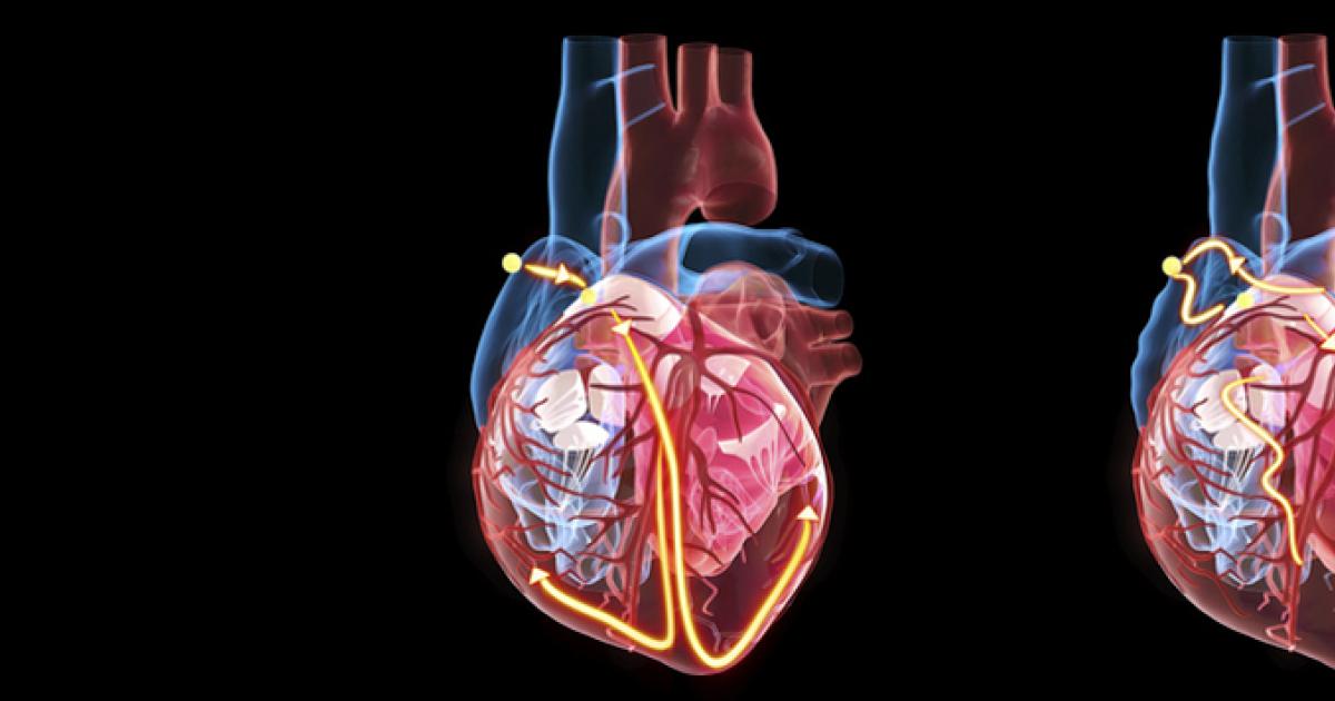 Atrial Fibrillation Animation
