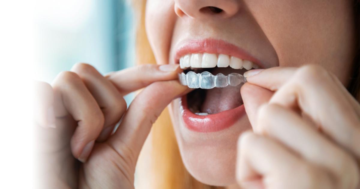 Teeth Aligners: Do They Work? | El Camino Health