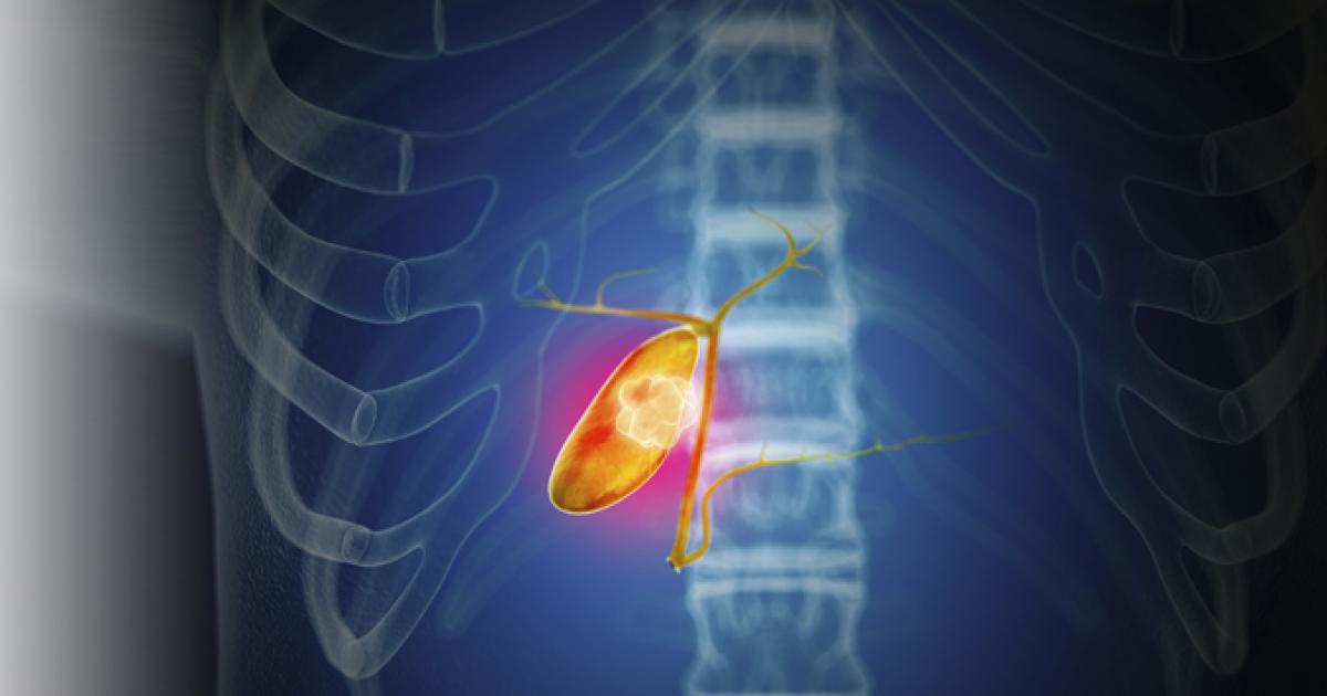 Gallbladder Attacks: What You Should Know | El Camino Health