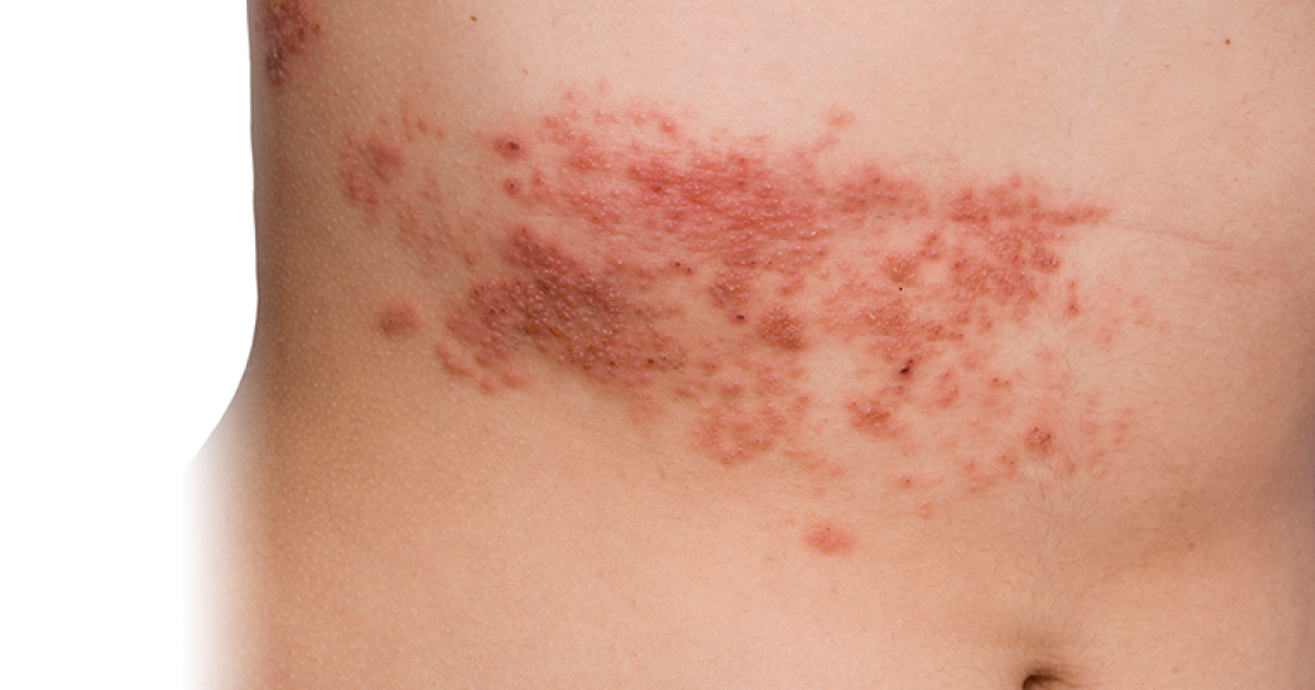 Understanding Shingles: Causes, Symptoms, and Treatment | Our Experts ...